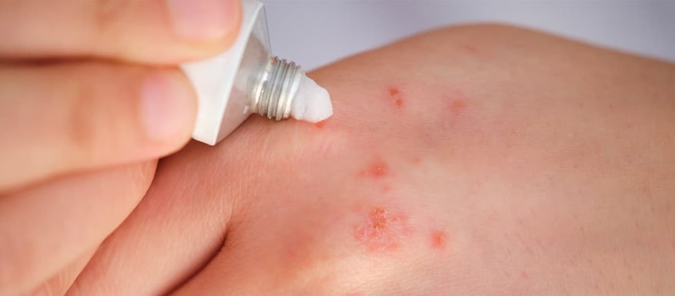 Eczema Dishidrótico En Los Pies DISHIDROSIS: QUÉ ES, SÍNTOMAS Y