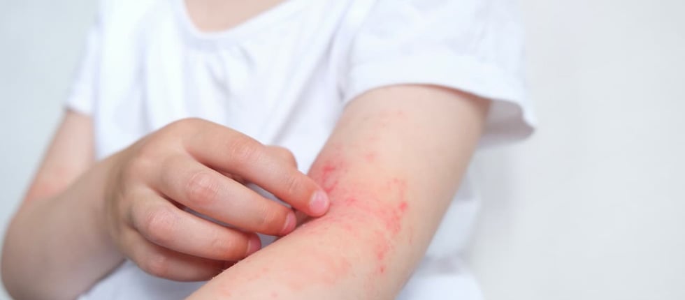 Eczema dishidrótico: Conoce sus causas y tratamiento | CeraVe