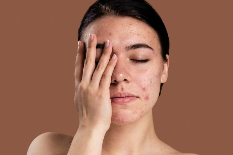 Granos en la piel: ¿cuáles son los síntomas y tratamientos? | CeraVe