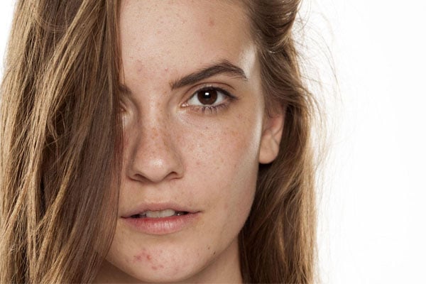 Espinillas: Qué son, Por qué aparecen, Tipos y Cómo tratarlas | CeraVe